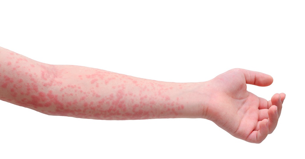 Dermatitis, Kenali Gejala, Penyebab, dan Pencegahannya
