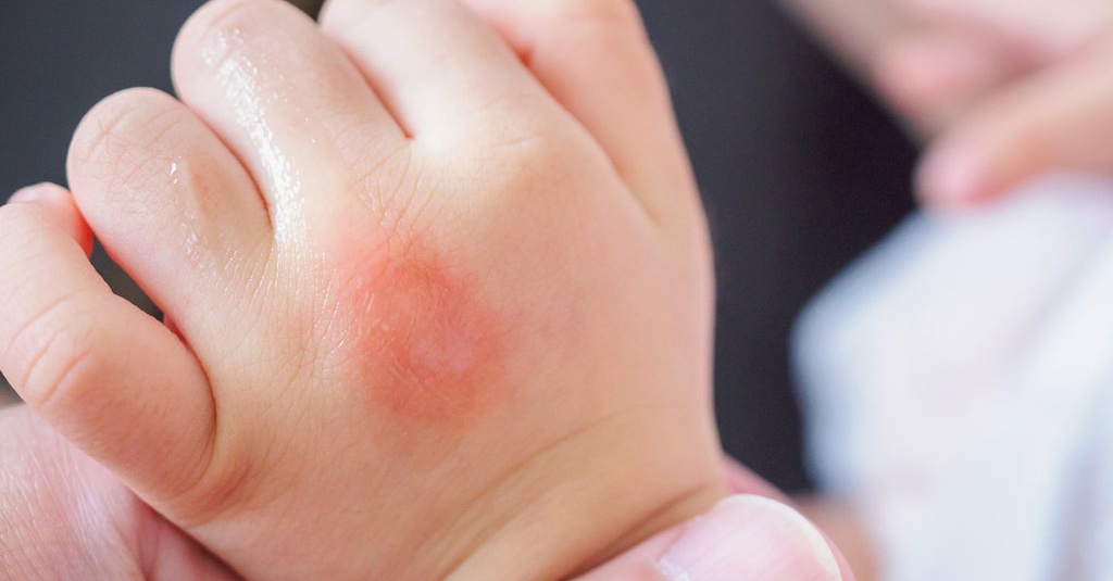 Mengenal Allergic March pada Bayi: Penyebab dan Cara Mengatasinya