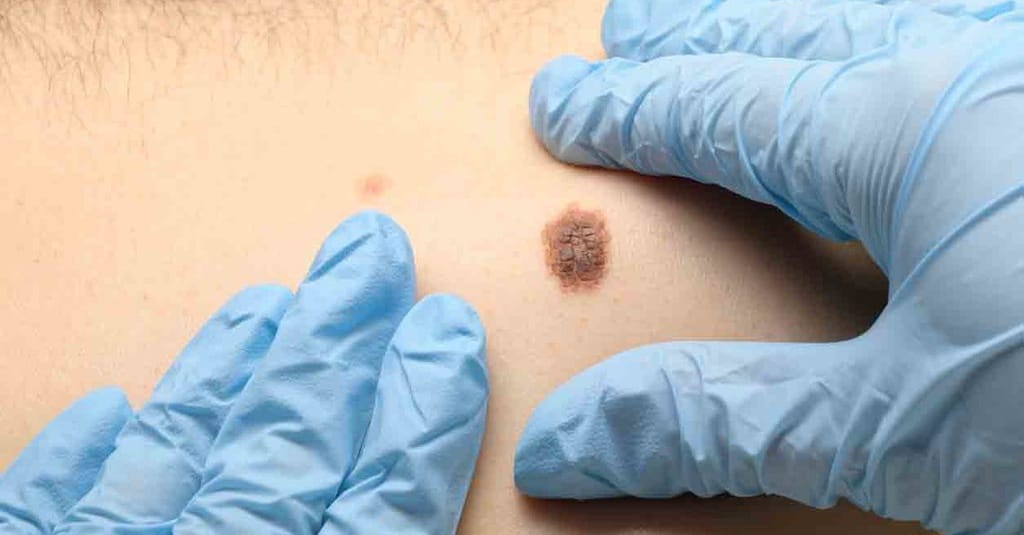 Cara Mudah Deteksi Kanker Kulit: Apa Tanda yang Perlu Diwaspadai?