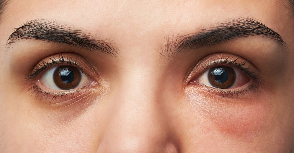 Apa Itu Racoon Eye atau Mata Rakun, Gejala hingga Penyebab