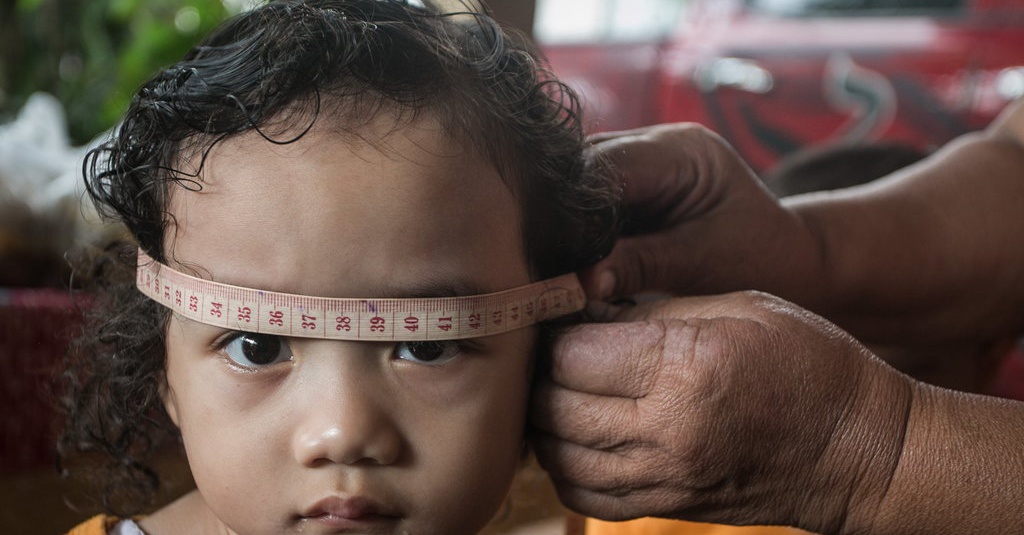 Ciri-ciri Stunting pada Anak 2 Tahun dan Vitamin yang Dibutuhkan