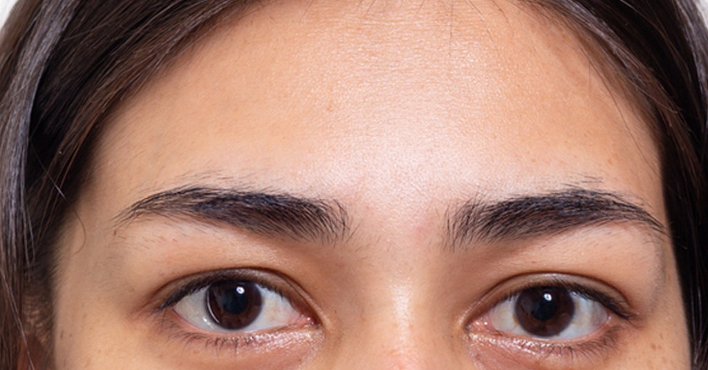 Mengenal Apa Itu Horner Syndrome, Gejala dan Penyebabnya