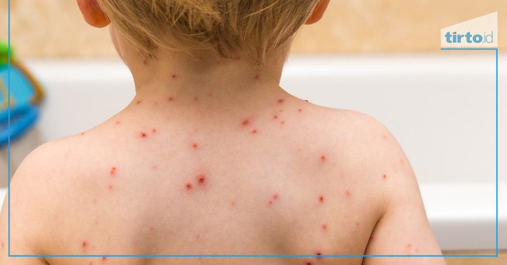 Gejala Cacar Air pada Anak dan Cara Penularannya