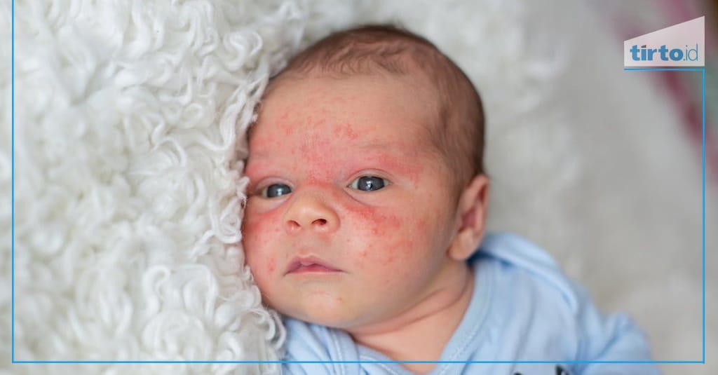 Cara Mengobati Eksim pada Anak yang Perlu Dipahami Orang Tua