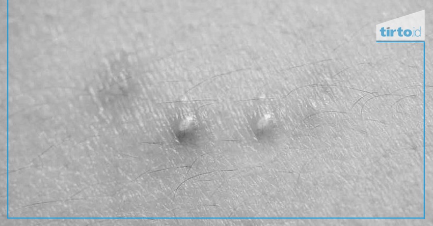 Cara Mengobati Bisul: Kompres Air Hangat hingga Operasi