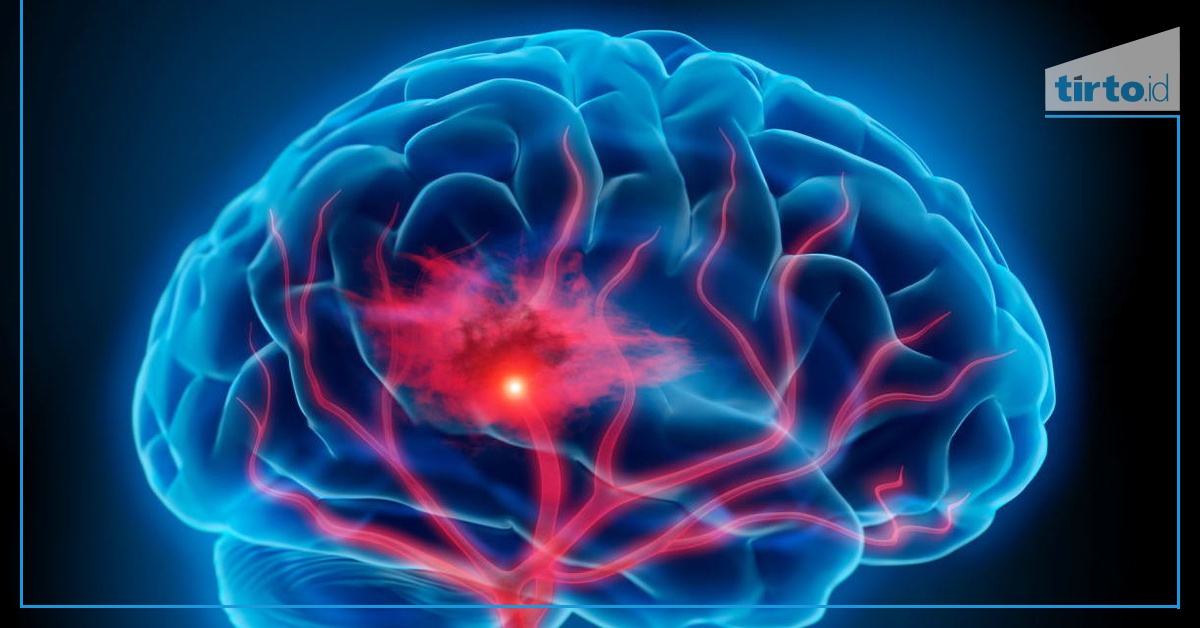 Mengenal Penyakit Atrofi Otak, Penyebab, dan Cara Mengatasinya
