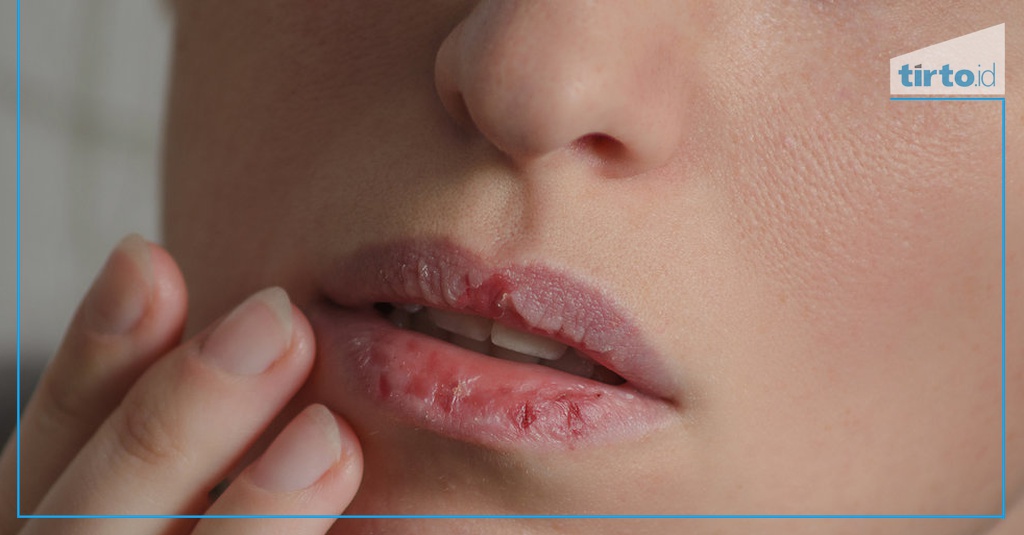 Apa Itu Skin Picking Disorder, 3 Penyebabnya, Gejala dan Efeknya