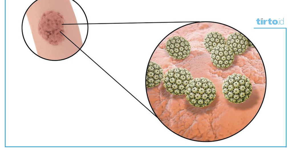 Apa Itu Penyakit Jengger Ayam, Gejala dan Penyebabnya?