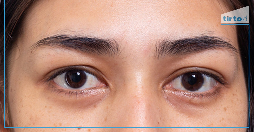 Mengenal Apa Itu Horner Syndrome, Gejala dan Penyebabnya