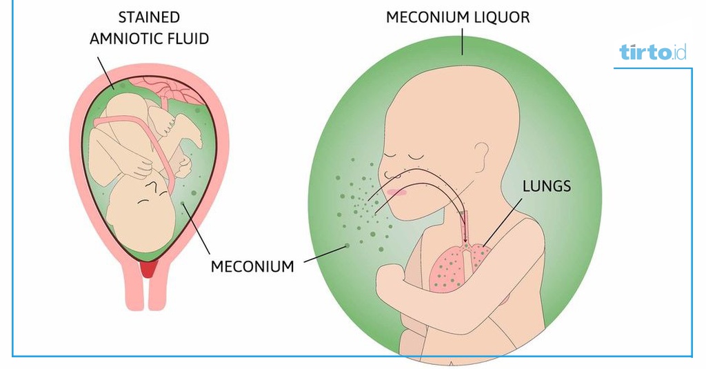 Apa Itu Meconium Aspiration Syndrome, Gejala dan Penyebabnya