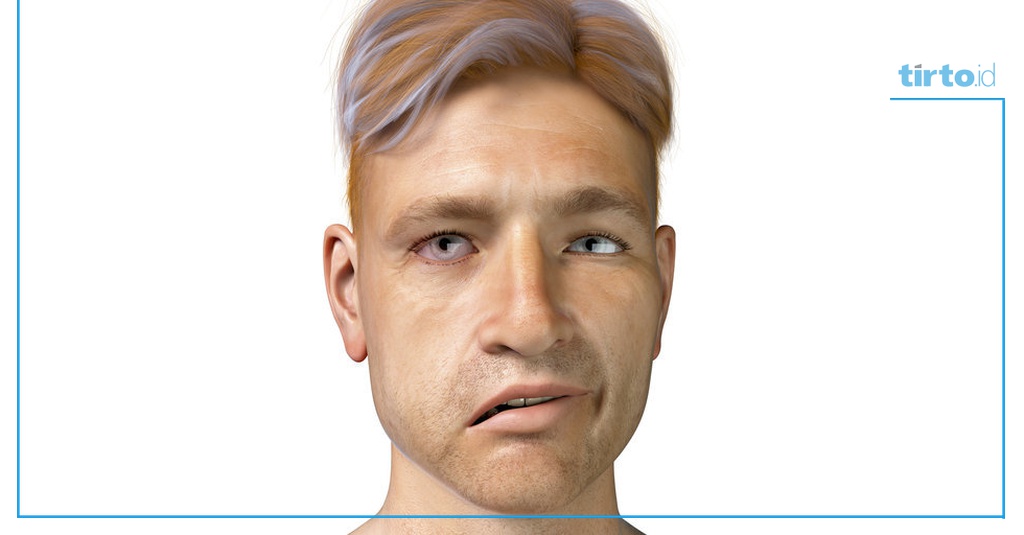 Apa Saja 22 Gejala Sindrom Parry-Romberg dan 7 Penyebabnya