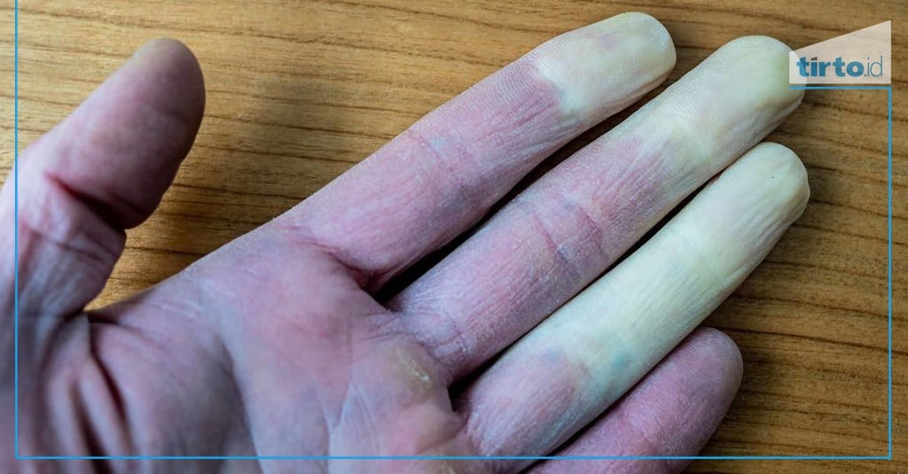 Apa Itu Sindrom Raynaud Ketahui Daftar Penyebab Dan 4 Gejalanya