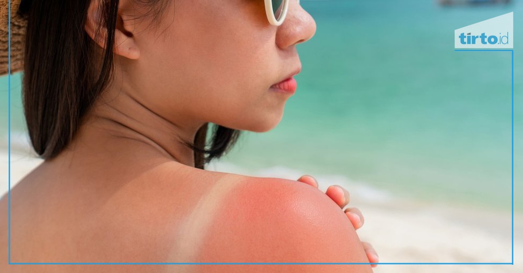 Cara Memutihkan Kembali Kulit yang Terbakar Sinar Matahari