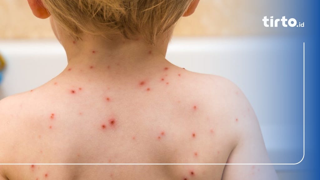 Gejala Cacar Air pada Anak dan Cara Penularannya