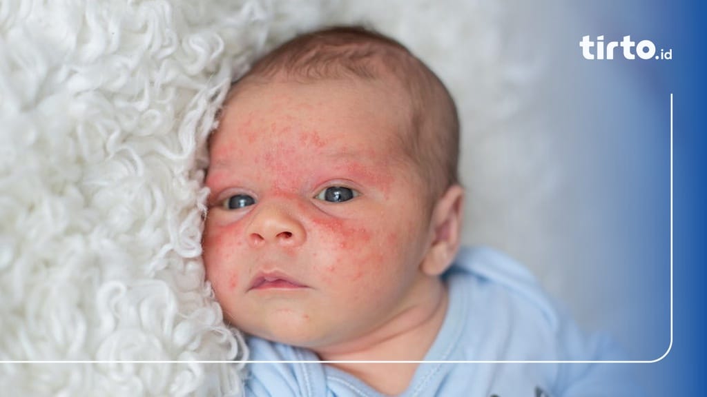 Kenali Gejala Eksim, Ruam dan Gatal pada Kulit Bayi