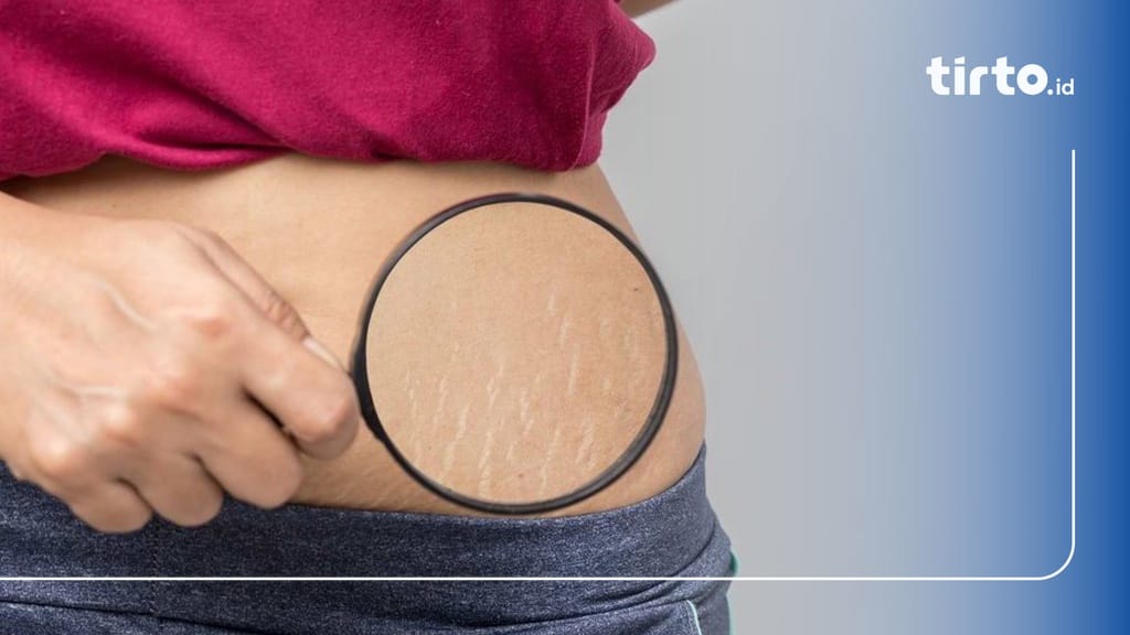 Perbedaan Selulit dan Stretch Mark yang Muncul di Kulit