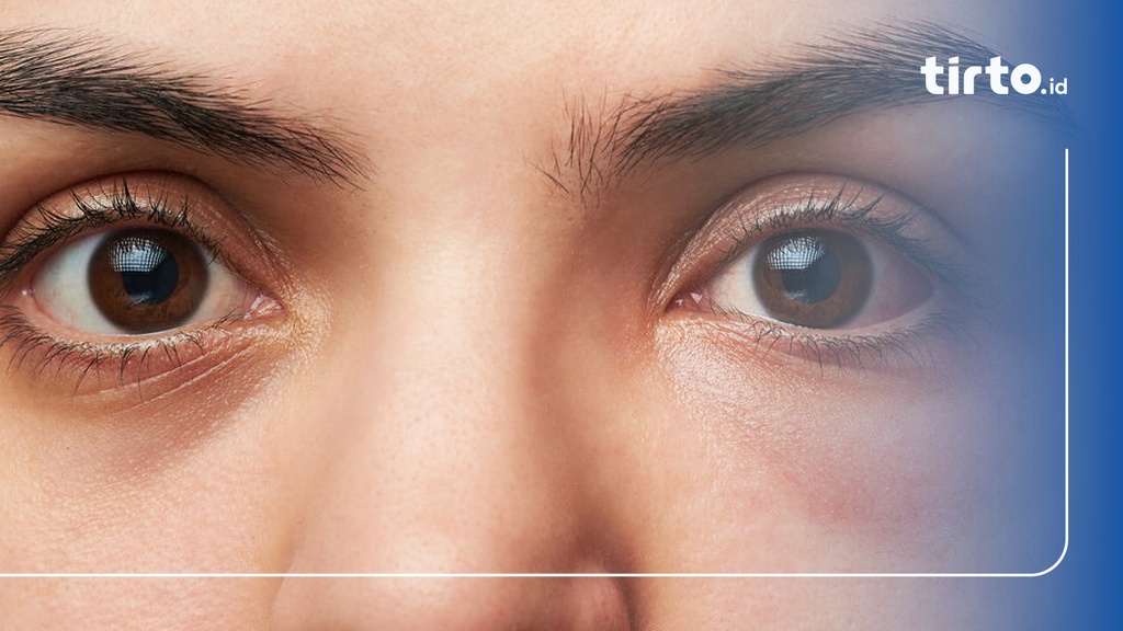 Apa Itu Racoon Eye atau Mata Rakun, Gejala hingga Penyebab