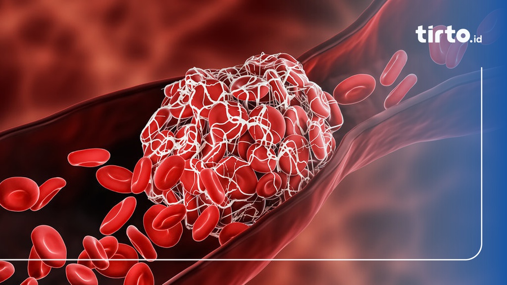 Tema Hari Trombosis Sedunia 13 Oktober 2022 & Apa Itu Trombosis?