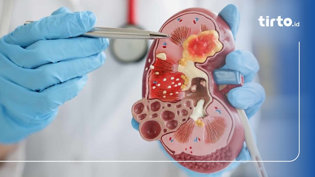 Cara dan Syarat Donor Ginjal Legal Serta Aman di Indonesia