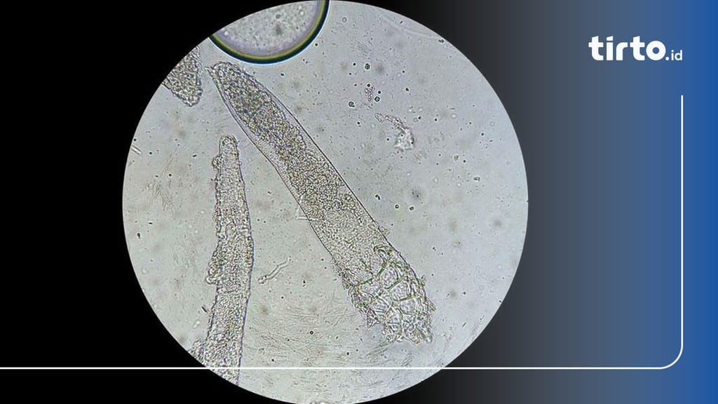 Cara Menghilangkan Tungau Demodex di Wajah & Penyebabnya