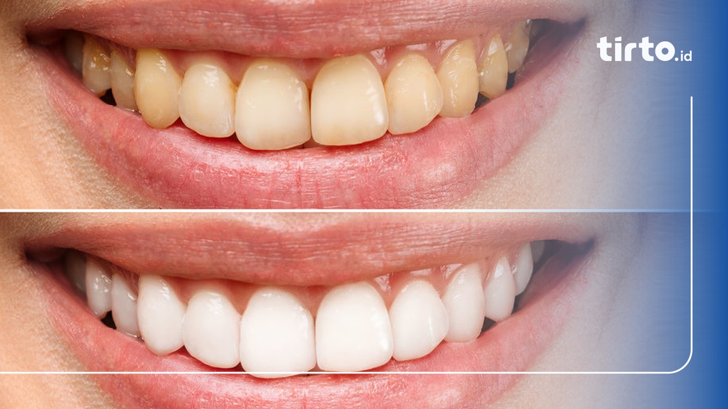 7 Cara Menghilangkan Gigi Kuning Secara Alami & Apa Penyebabnya