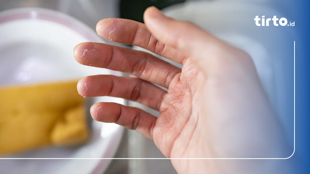 6 Gejala Alergi Sabun Cuci Piring dan Cara Mengatasi