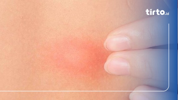 Obat Digigit Semut Api dan Pertolongan Pertamanya