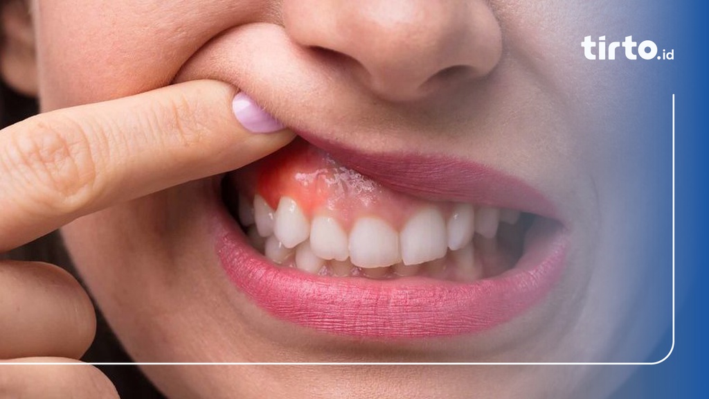 7 Penyebab Benjolan di Gusi dan Cara Mengatasinya