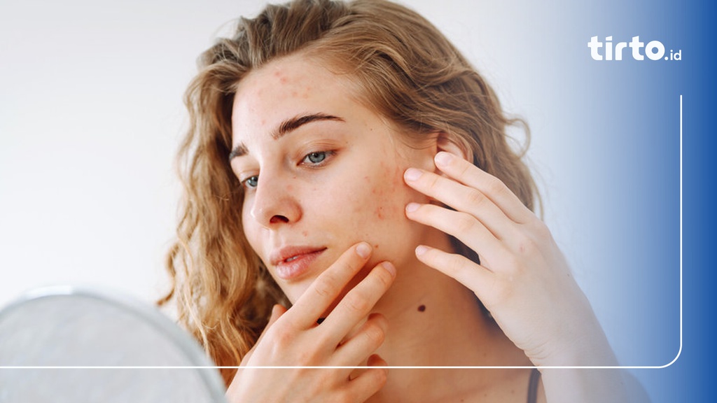 Apa itu Comedogenic pada Skincare? Ini Penjelasan dan Efeknya