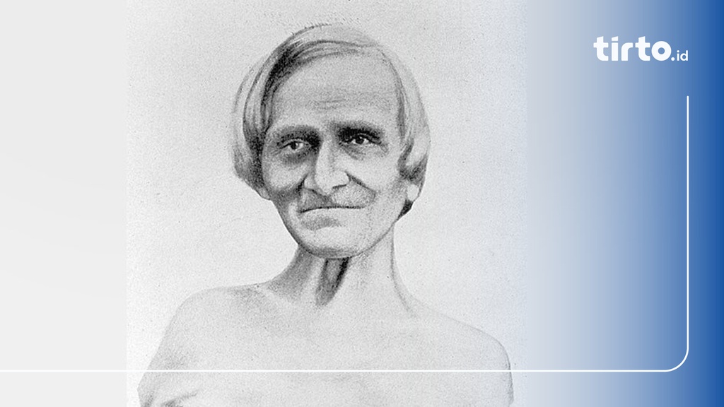 Alexis St. Martin, Kisah Tragis di Balik Ilmu Pencernaan