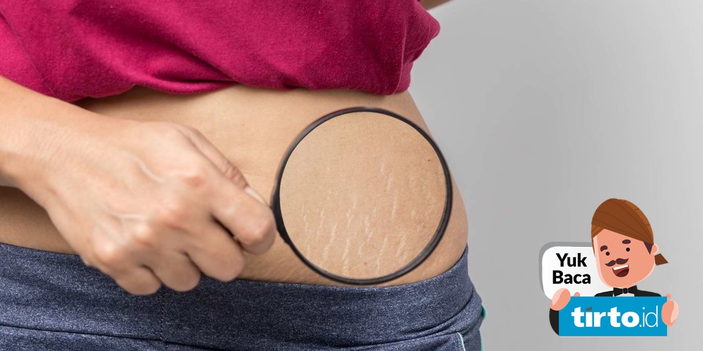 Perbedaan Selulit dan Stretch Mark yang Muncul di Kulit
