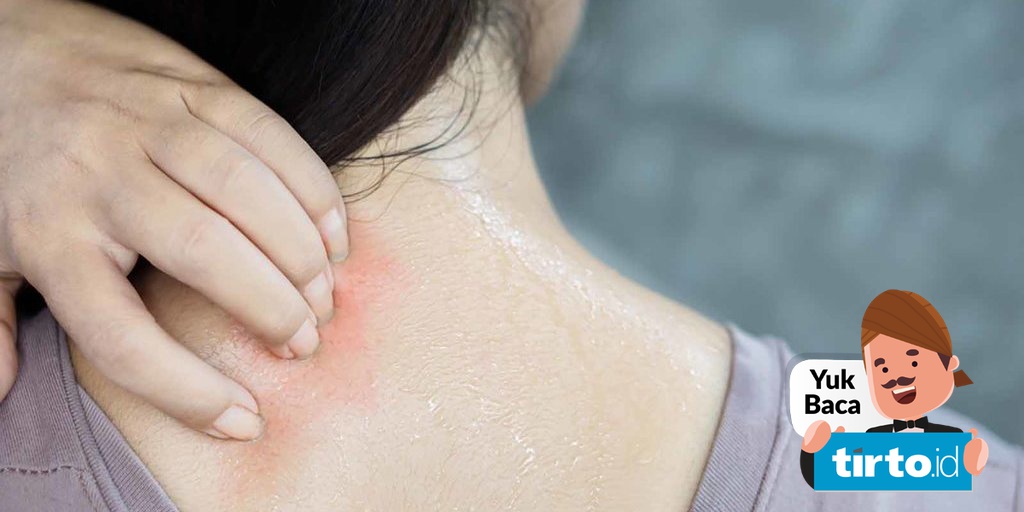 Cara Mengatasi Iritasi Kulit dengan Bahan-Bahan Alami